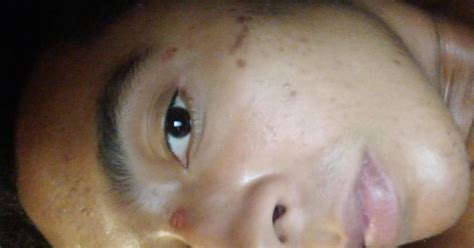 Scabs Appearing But I Didnt Cut Myself Findatopdoc