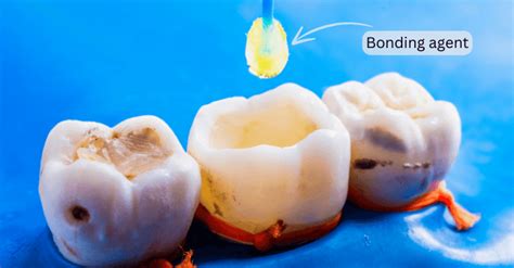 Tooth Colored Fillings A Guide To Composite Dental Fillings Share