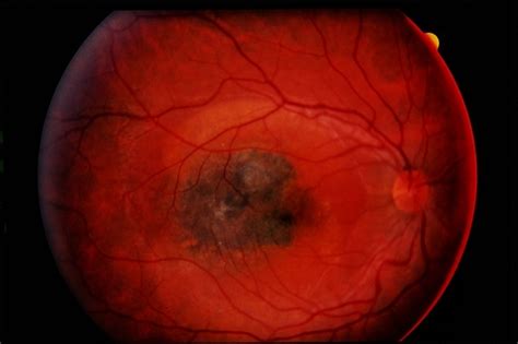 Choroidal Melanoma Retina Image Bank