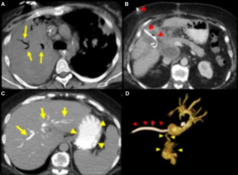 Imaging In Laparoscopic Cholecystectomy—what A Radiologist Needs To Know European Journal Of