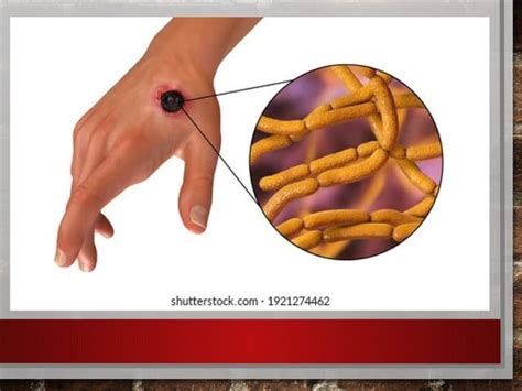 Anthrax Disease And Its Preventionpptxxx Ppt