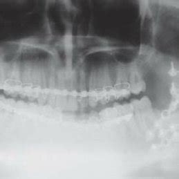 Left Ramus Fractures Plated At 2 Points Accompanied By Angle Fracture