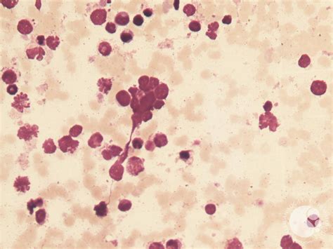 Bone Marrow Morphology And Flow Cytometry Plots 1