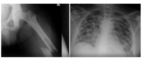 Imaging Investigations For Diagnosis Of Pulmonary Embolism Flashcards