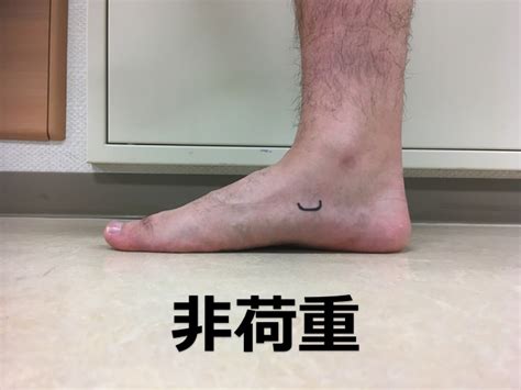 有痛性外脛骨の理学療法はアイシングとストレッチングだけでいいの？ 理学療法士の働き方改革