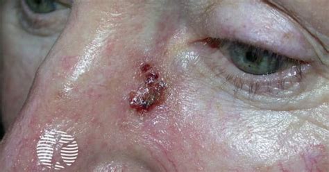 Squamous Cell Carcinoma Image