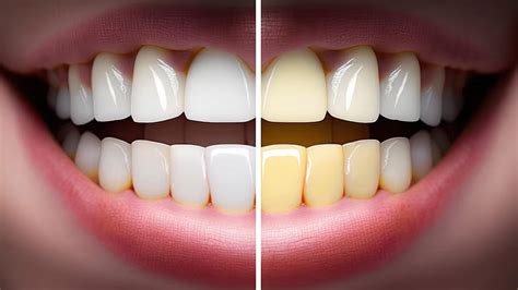 Teeth Whitening பற்களில் மஞ்சள் கறையை போக்கும் ஈஸியான வழிமுறைகள்