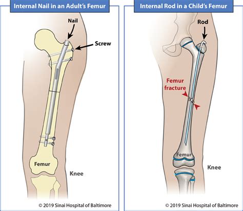 Intramedullary Rod Tibia