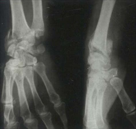 Case 2 Preoperative Radiograph Anteroposterior And Lateral View