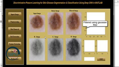 Discriminative Feature Learning For Skin Disease Classification Using Deep Cnn Matlab
