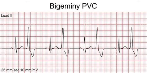 Bigeminy Premature Ventricular Contractions Uml Center For Systems Research