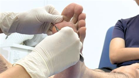 Corn And Callus Symptoms Causes And Treatments In Singapore