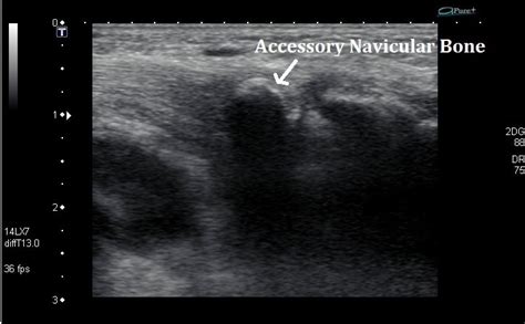 Ultrasound Imaging Of The Accessory Navicular Bone Ankle Foot And