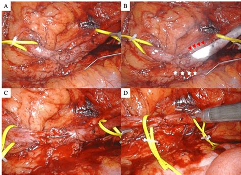 Robot Assisted Ureteroureterostomy In A Patient With Left Ureteral Download Scientific Diagram