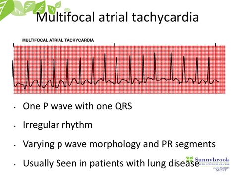 Multifocal Atrial Tachycardia 心房 頻拍 計算 Uajam