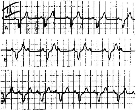 A Lead Ii Ecg In A Patient With Syncope Intraventricular Conduction