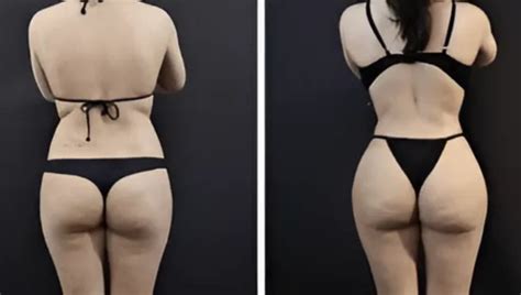Skinny Bbl Recovery Timeline For Dallas Patients Skinny Bbl Near Me