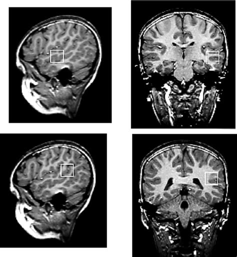 T 1 Weighted Gradient Echo Magnetic Resonance Images Showing Placement Download Scientific