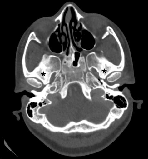 Cerebral Ct Scan Showing The Absence Of The Foramen Spinosum A Typical