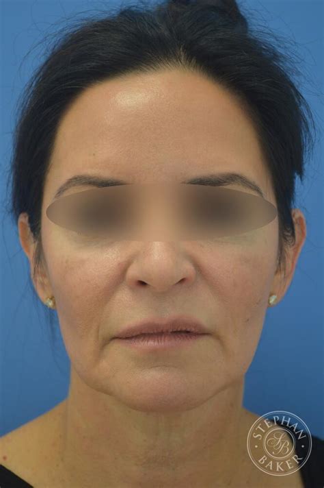 Before And After Face And Neck Lift Procedures In Miami Fl Dr Baker
