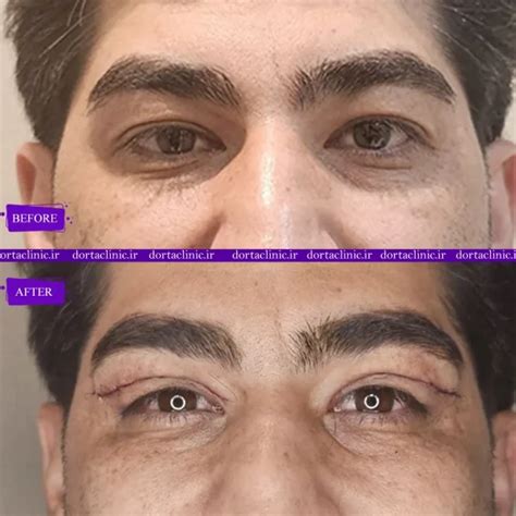 نمونه کار بلفاروپلاستی کلینیک زیبایی درتا