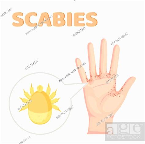 Scabies Contagious Skin Infestation Scabies Mite And Human S Skin With Magnified View Of A