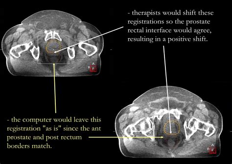 A Retrospective Analysis Of Prostate Cone Beam Computed Tomography