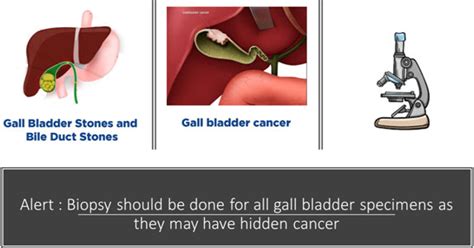 What Should Be Done If Cancer Is Found In Gall Bladder After Gall