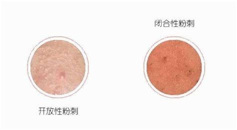 白头粉刺清晰图片白头和黑头的区别图片白头粉刺图片第8页大山谷图库
