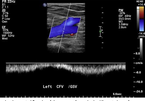 Venous Doppler Cpt Code 2025 John Holt