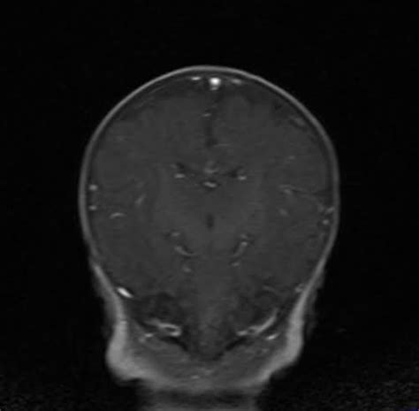 Plan Ped Brain Localizer Mrimaster