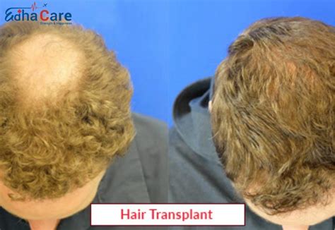 Lip Augmentation Surgery Fat Transfer Fillers Side Effects