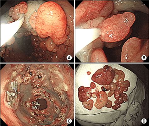 Endoscopic Polypectomy A B Multiple Endoscopic Removals Each Download Scientific Diagram