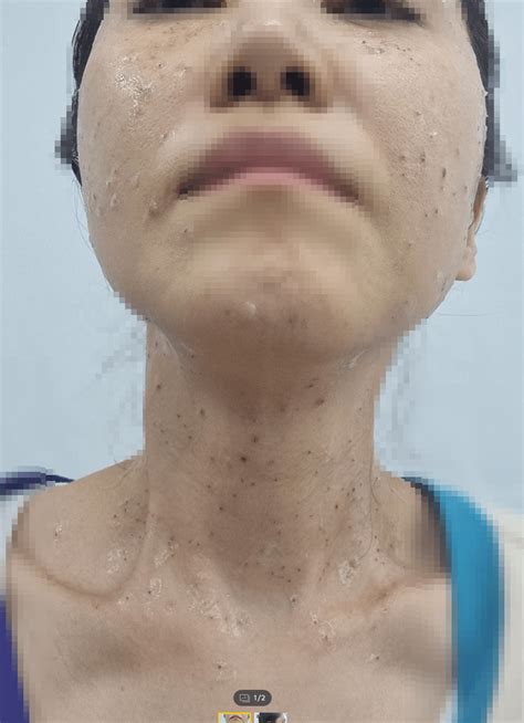 편평사마귀 한관종 비립종 점 제거 레이저 내돈내산 3일째 경과 2