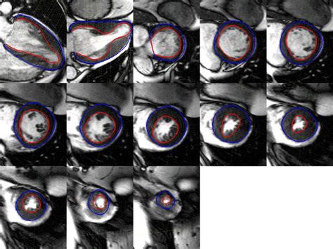 Different Segmented Cmr Acquired Contours On A Severe Abnormal Anatomy Download Scientific
