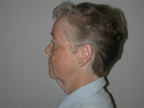 What Is A Mini Neck Lift Birmingham Al