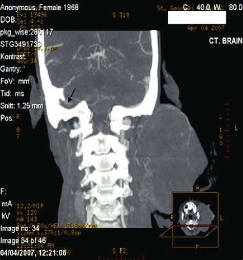 Right Transverse Sinus Thrombosis Arrow Showing The Absence Of
