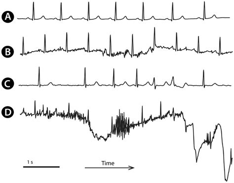 Examples Of Holter Ecg Signals Normal Sinus Rhythm A The Same