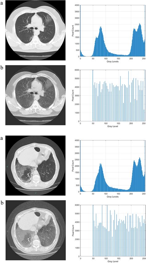Results Of The Ct Scan Image Enhancement With Histogram Analysis A