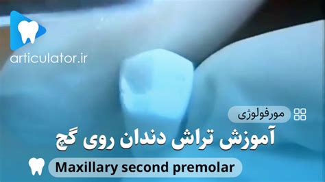 آموزش تراش دندان پره مولر دوم ماگزیلا 5 بالا روی گچ