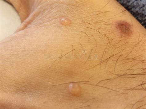 Monkeypox Disseminated Skin Lesions Gay White Male Stock Image