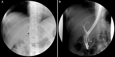 A Plain Abdominal Radiograph Taken Prior To Endoscopic Retrograde
