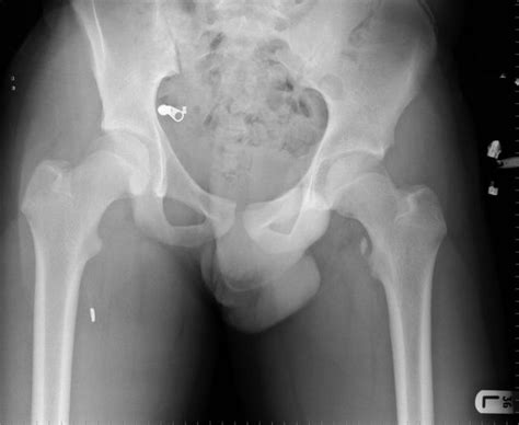 Apophyseal Avulsion Fractures Of The Pelvis And Hip Pacs