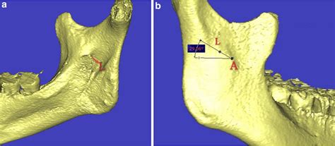 Al Lingula On Cbct B The Angle Between The Outer Projection Point Of