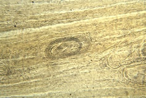 Trichinella Nativa Agentes Biológicos Parásito