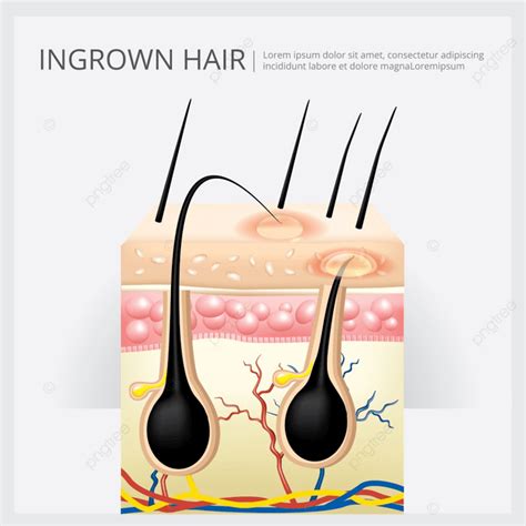 Ingrown Hair Diagram