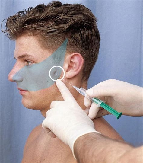 Trigeminal Neuralgia Intervention Pain Clinics