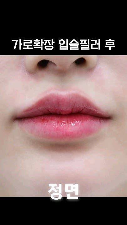 오버립이 필요없는 도톰한 입술💋 만들고 싶어요 가로확장입술필러 Youtube