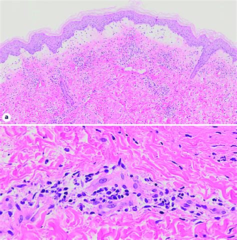 A A Skin Biopsy Taken From A Vesicular Lesion On The Right Lower