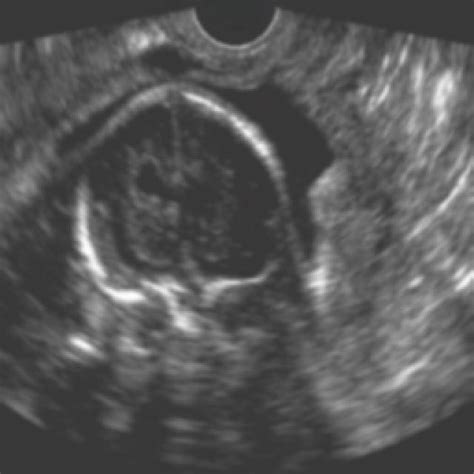 Classintracranial Tumor Roboflow Universe Search